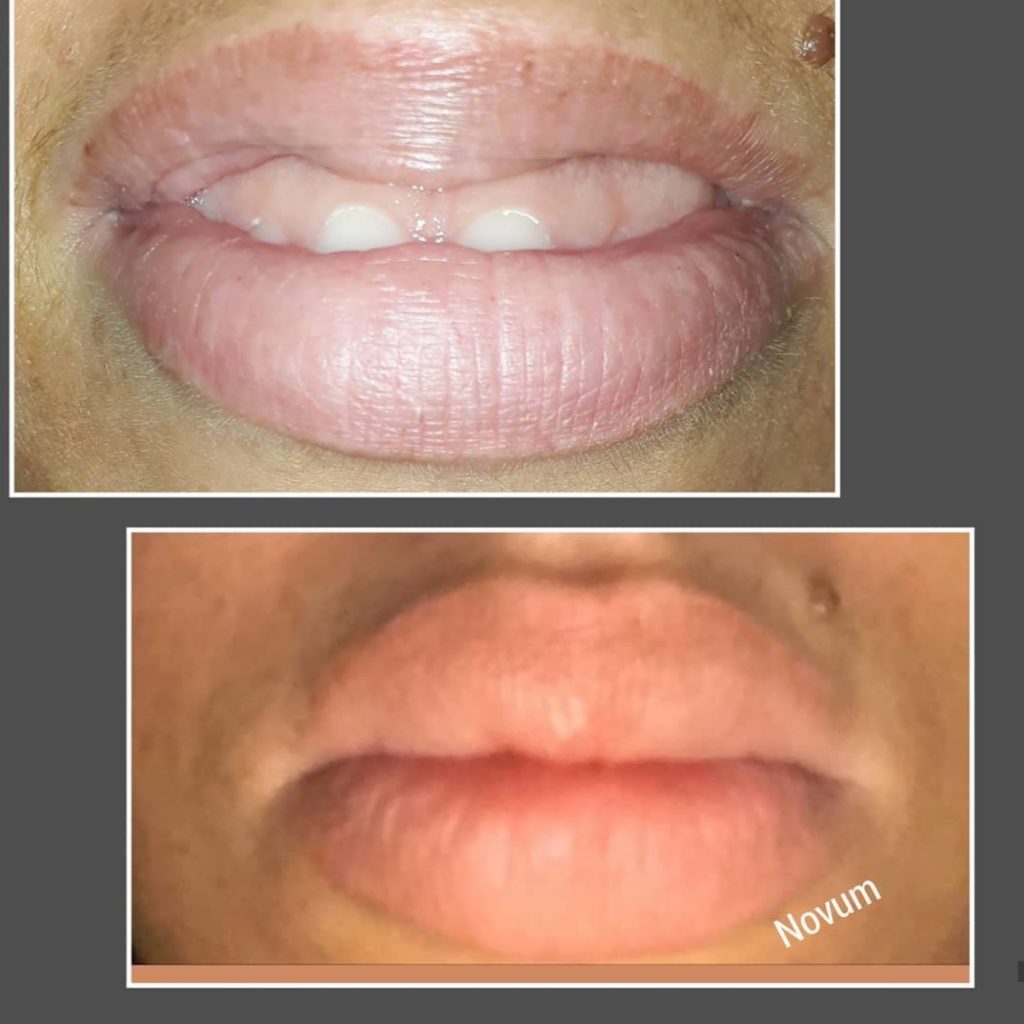 Lip Fillers | Novum Aesthestics